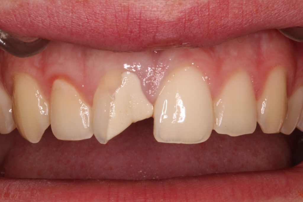 Contact Sport & Dental Trauma - Balham Dental Studio