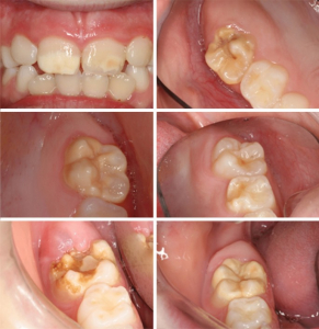 Hypomineralisation - Balham Dental Studio