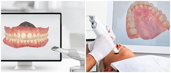 Digital Impression Scanning now Available - Balham Dental Studio
